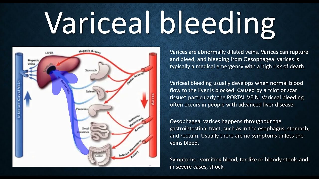 Chp 3. Variceal bleeding, Esophageal Varices, Oesophageal, USMLE ...