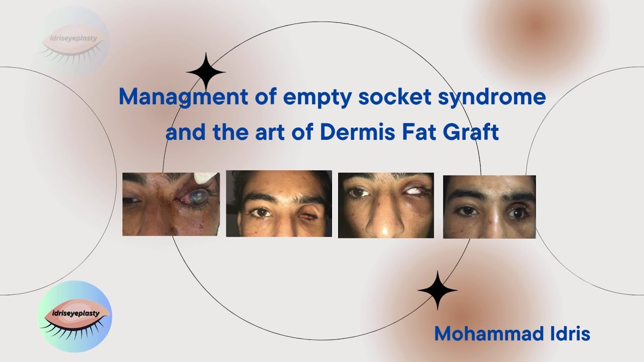Management of empty socket syndrome and the art of Dermis Fat Graft ...