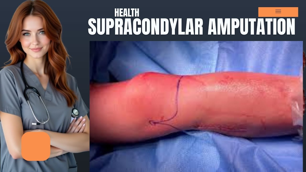 supracondylar amputation - YouTube