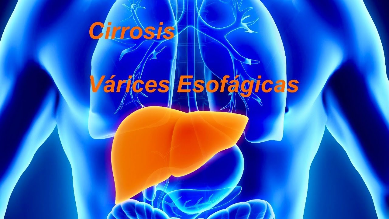 Cirrosis Hepatica y Várices Esofágicas - YouTube
