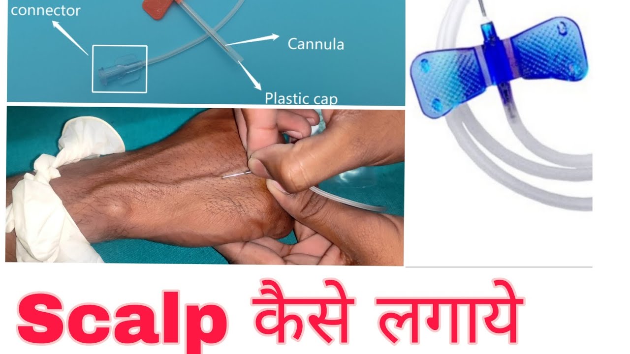 iv scalp kaise lagaye. #scalp#cannula - YouTube