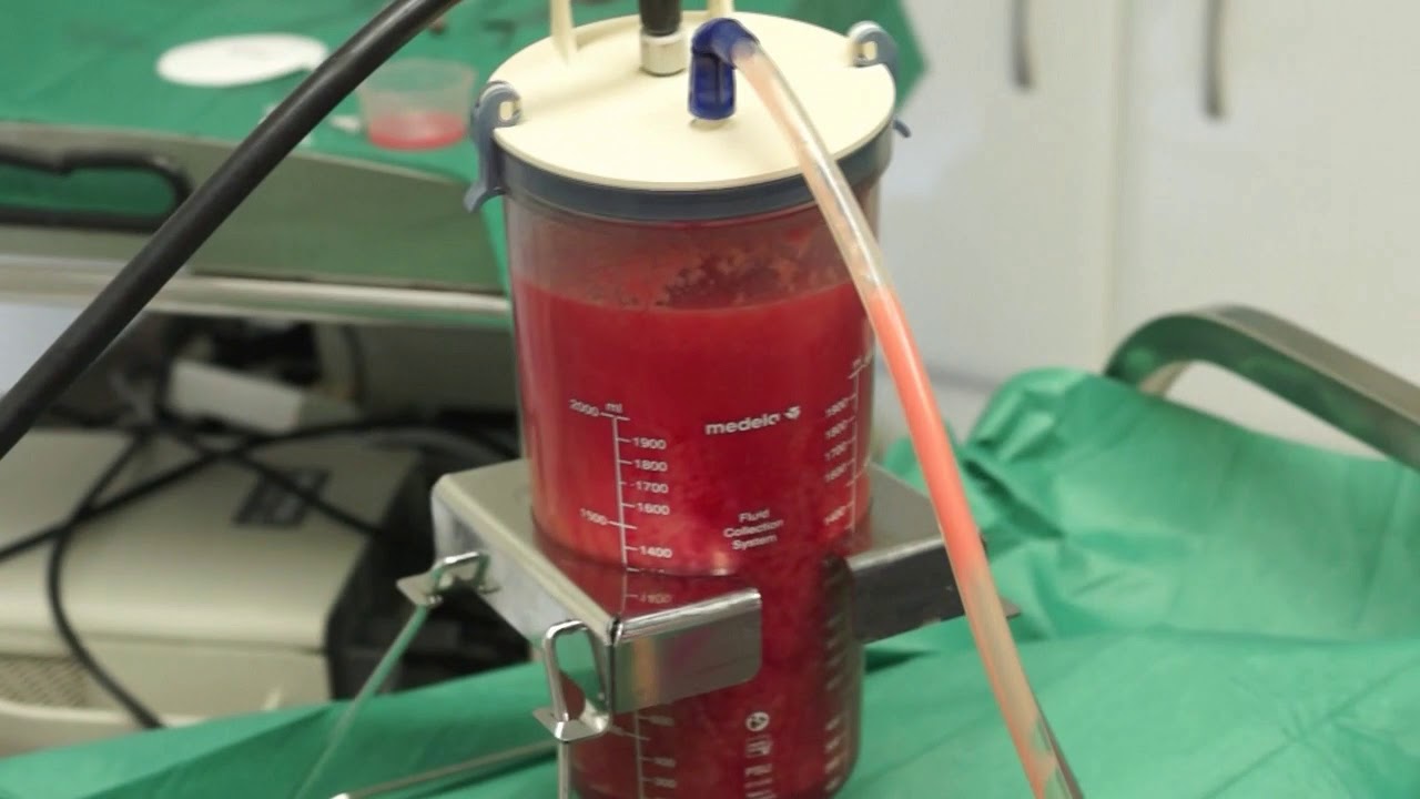 lipo waist under local anaesthetic - YouTube