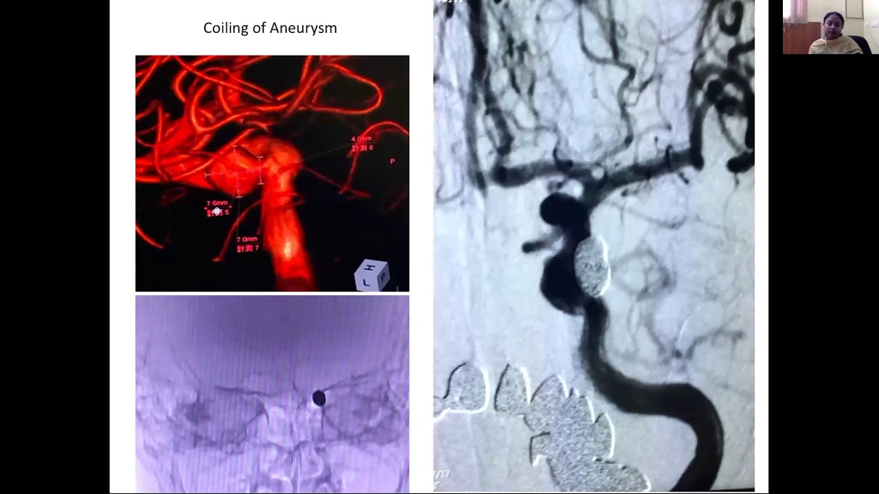 Fujita Japan Medical Center Neurosurgery Conference Nov 3, 2018 - YouTube