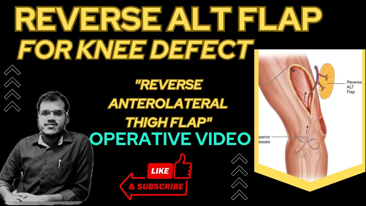 REVERSE ANTEROLATERAL THIGH FLAP | REVERSE ALT FLAP - YouTube