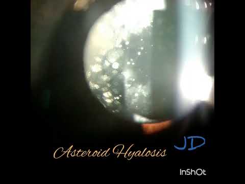 Asteroid Hyalosis - YouTube