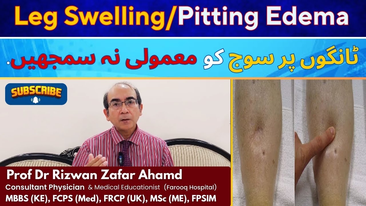 Leg Swelling / Pitting Edema – Don’t Ignore This Warning Sign! - YouTube