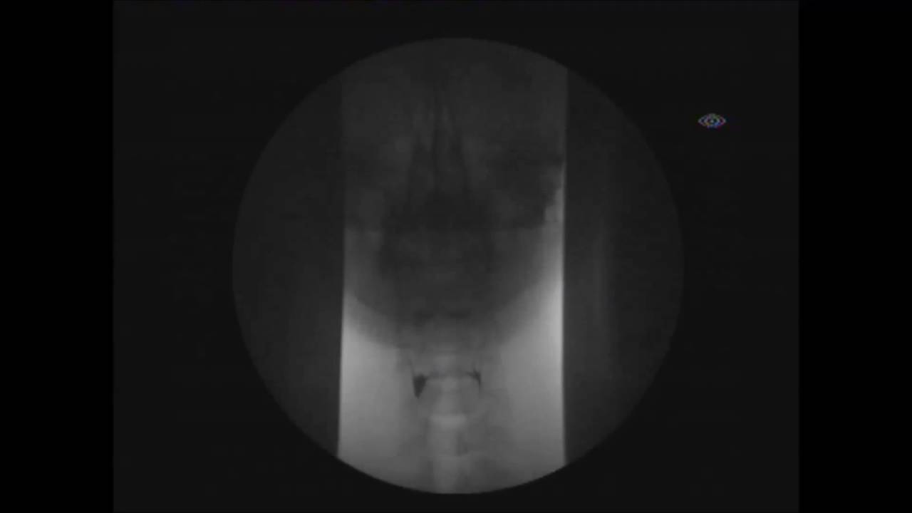 VFS - Videofluoroscopy Assessment of Swallowing - Röntgen Schluckakt ...