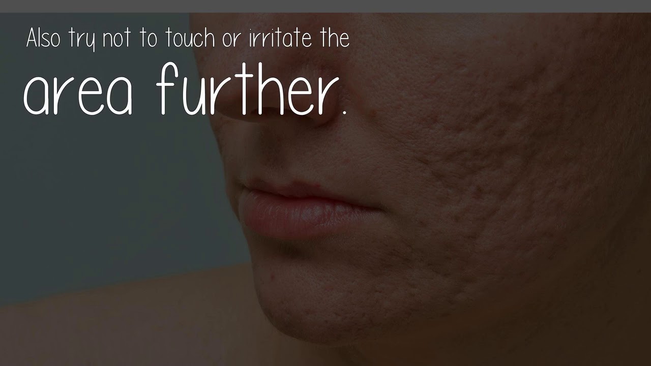 How Can I Treat Exercise Exacerbated Bad Acne On My Shoulders? - YouTube