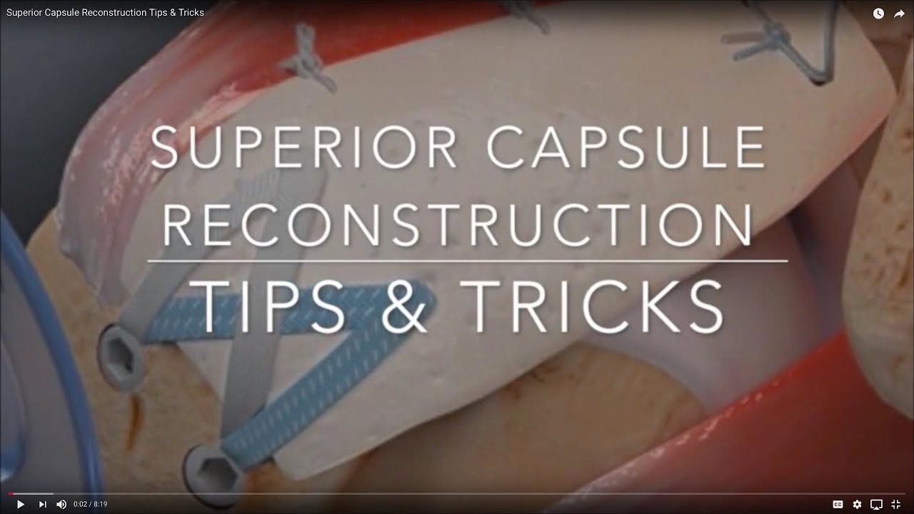 Superior Capsule Reconstruction Tips & Tricks - YouTube