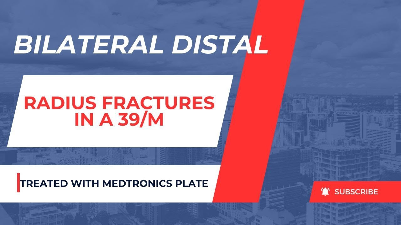 BILATERAL DISTAL RADIUS FRACTURES IN A 39/M TREATED WITH MEDTRONICS VA ...