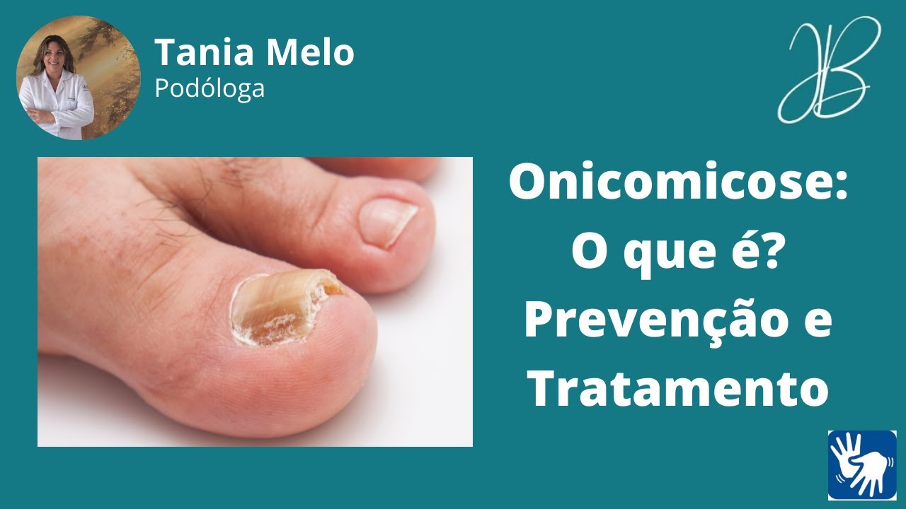 Onicomicose: O que é? Prevenção e Tratamento - YouTube