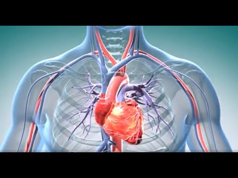 Shockwave + Neovasc Reducer Implant - YouTube