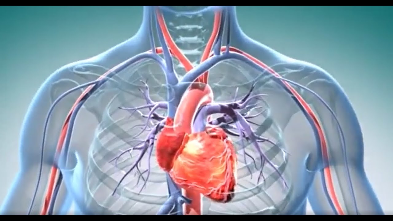 Shockwave + Neovasc Reducer Implant - YouTube