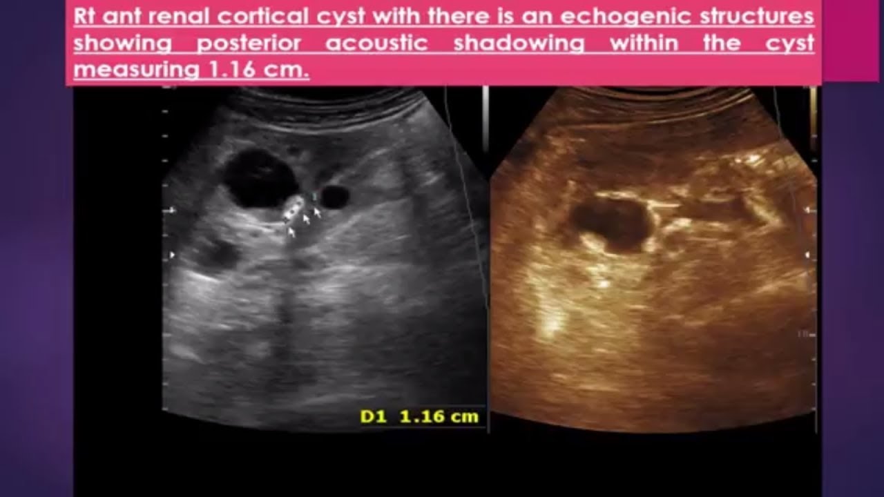 Rt renal cortical cyst with calculi - YouTube