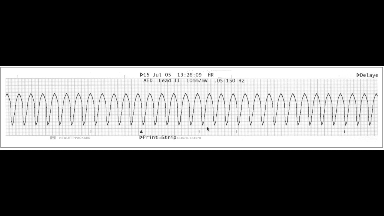 Shockable rhythms - YouTube
