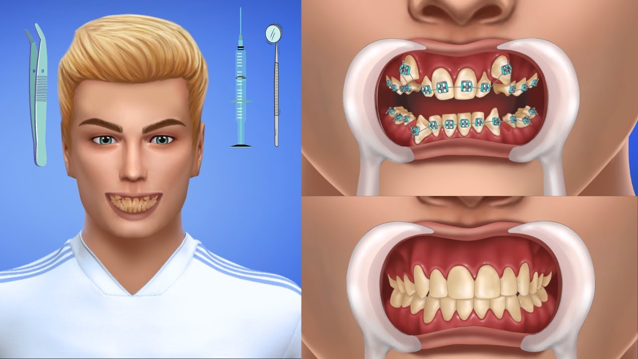 How Braces installed | ANIMATION | - YouTube