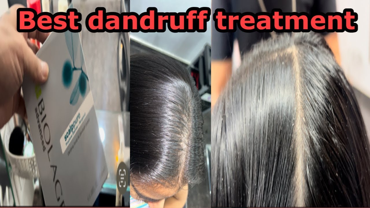 How To Dandruff Removal | Dandruff Treatment Step By Step - YouTube