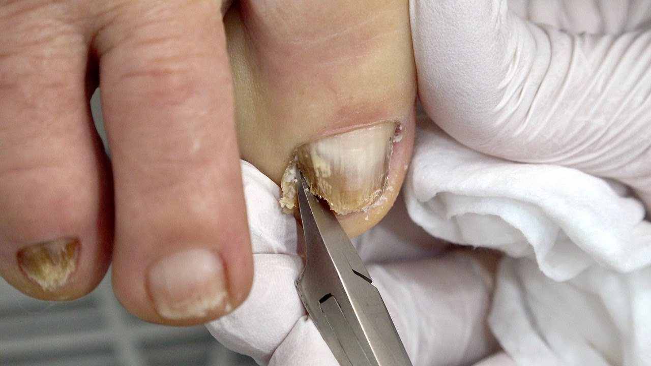 Satisfying Ingrown Toenail Removal Treatment Process. Korean Pedicure ...