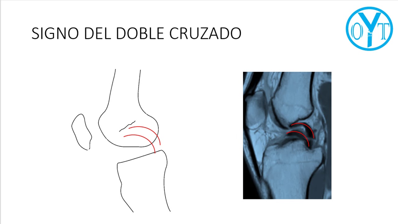 ruptura meniscal en asa de balde - YouTube