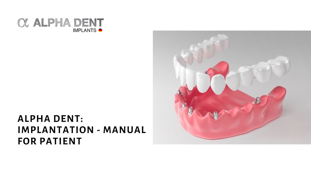 Alpha Dent: implantation - manual for patient - YouTube