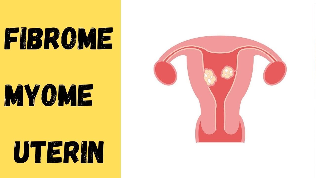 Fibrome/myome utérin - YouTube
