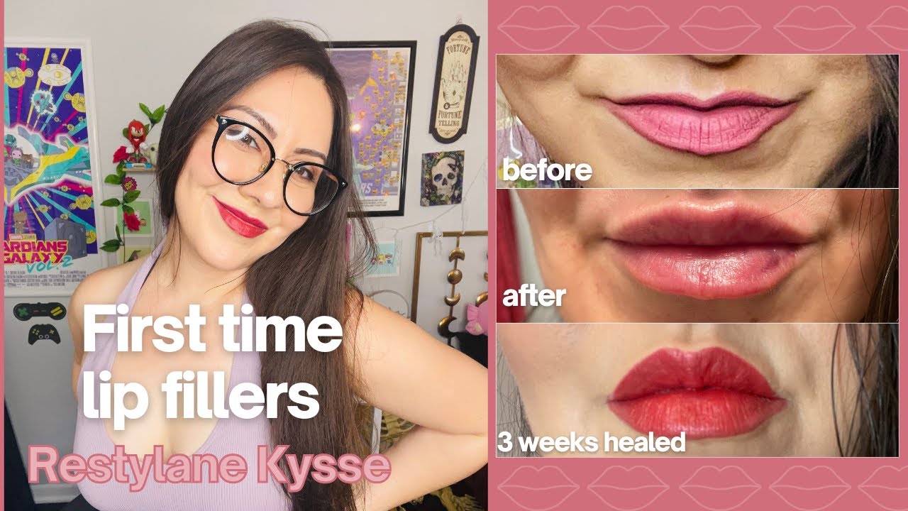 I Got Restylane Kysse Lip Filler & Instantly Regretted It!? 🤔💋 - YouTube