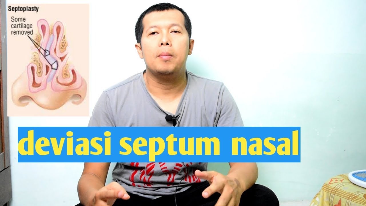 Deviasi septum nasal hidung buntu sinusitis polip anxiety hidup sehat ...
