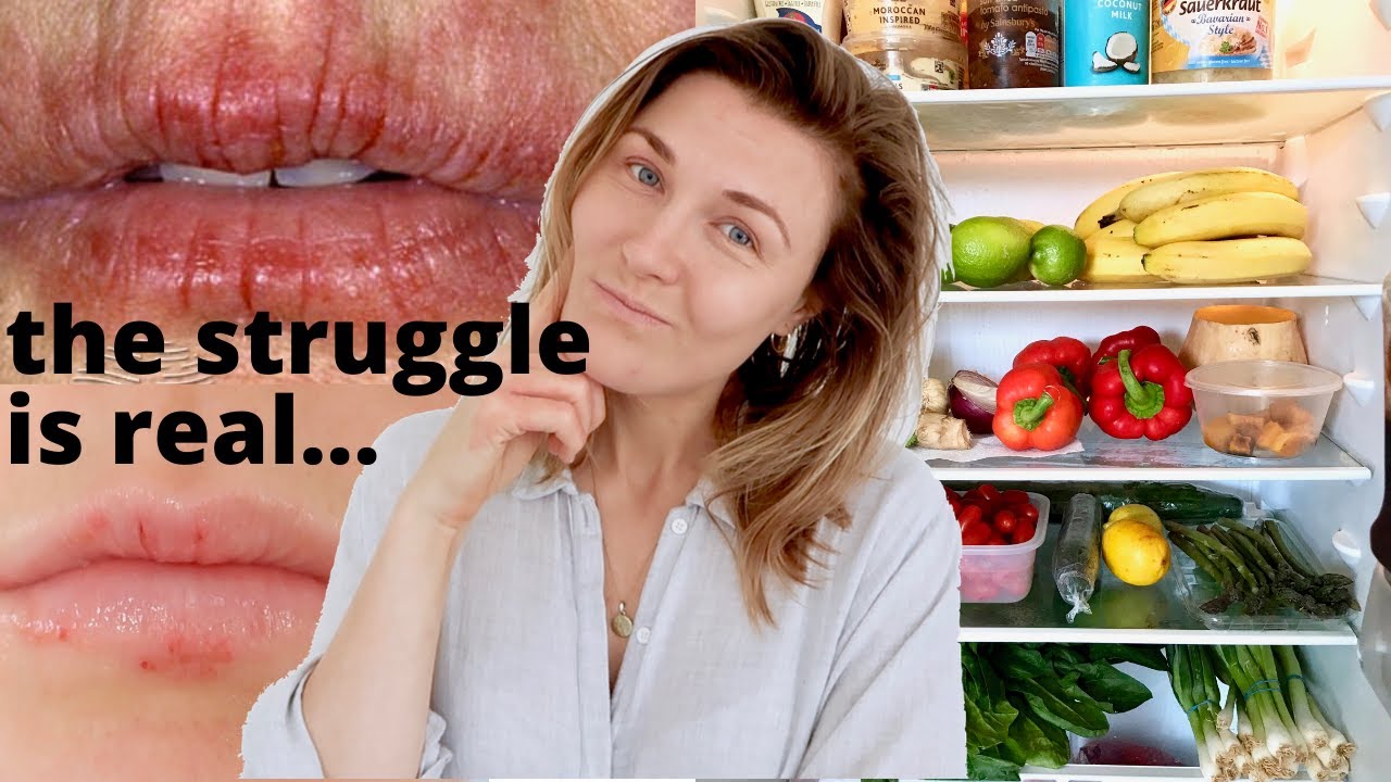 Eczema On The Lips What Foods To Eat And Avoid When You Have Angular eczema-on-the-lips-what-foods-to-eat-and-avoid-when-you-have-angular