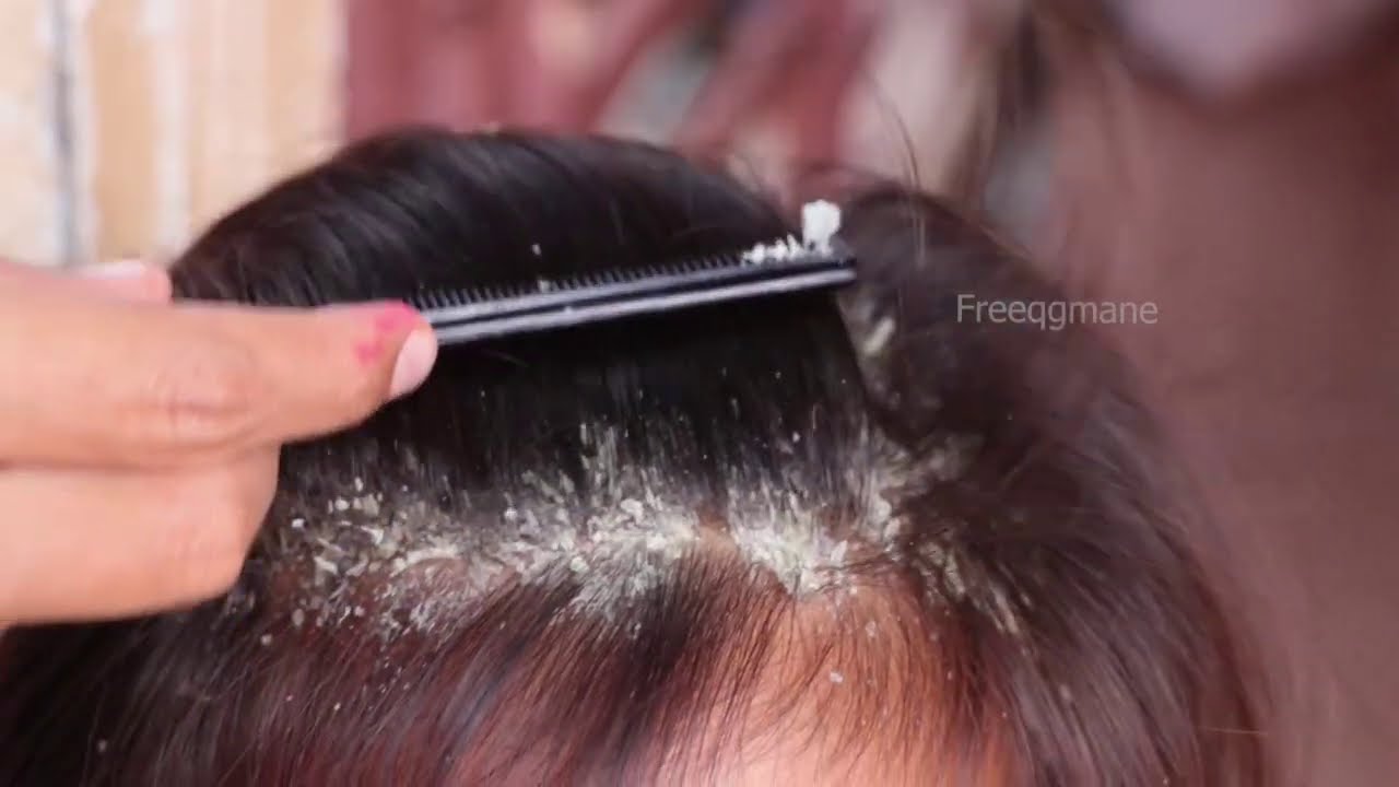 Giant Flakes!! | Big Dandruff Scratching Scalp Removal on Sister's head ...