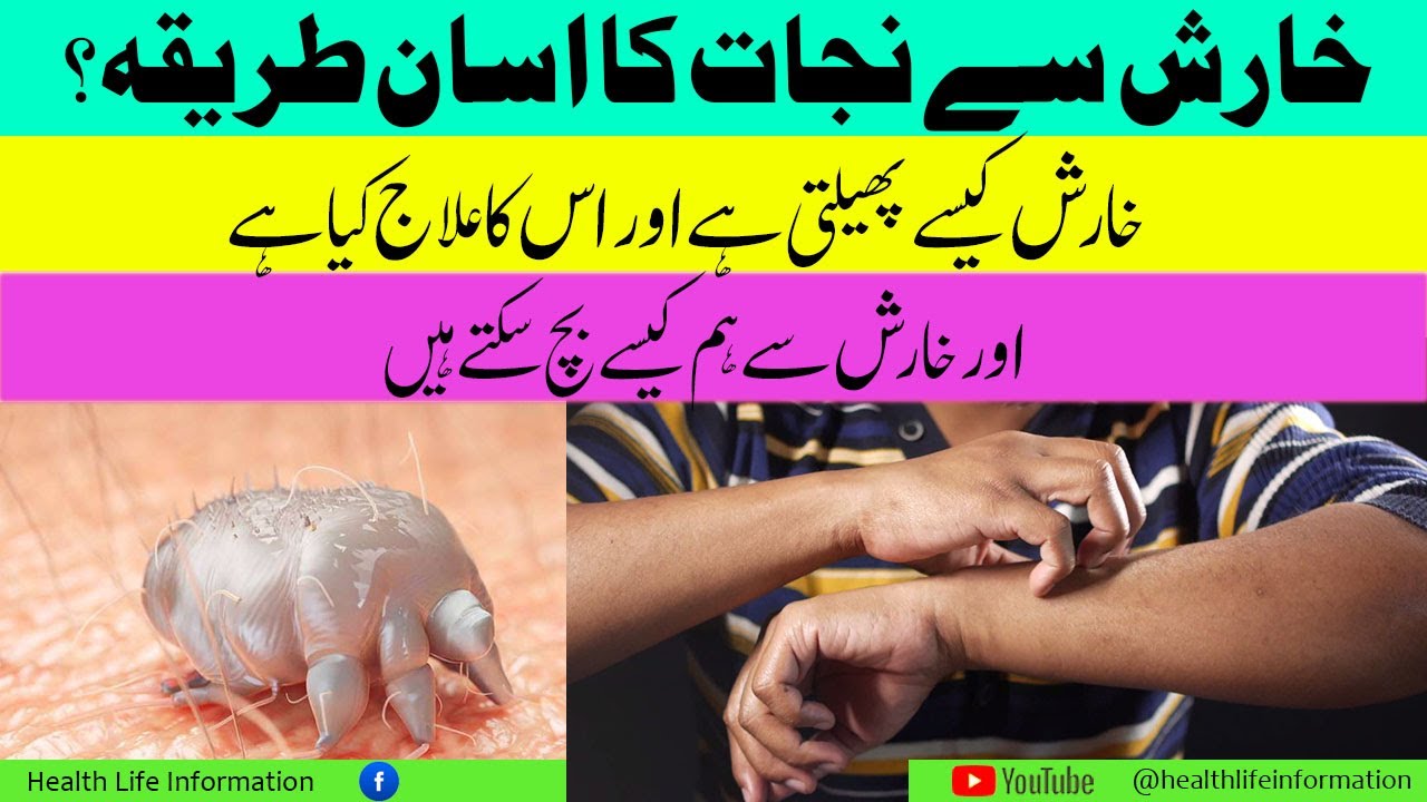 Kharish Khatam Karne Ka Tarika |Itchy Skin: Kharish Ka Ilaj | Scabies ...