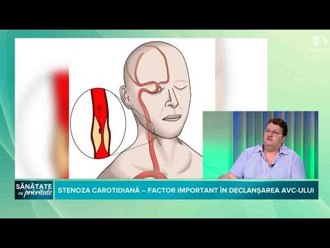 De ce apare stenoza carotidiana & ce presupune tratamentul chirurgical ...