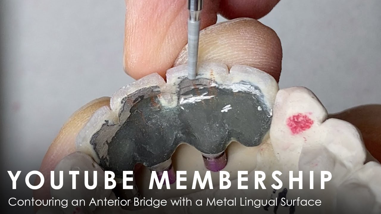 Contouring an Anterior Bridge with a Metal Lingual Surface - YouTube
