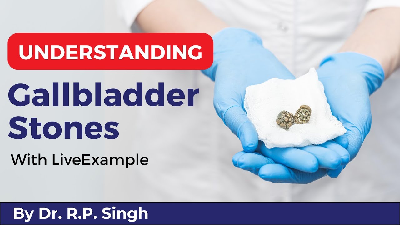 Understand Gallbladder Stones with Live Examples By Dr. Ravinder Pal ...