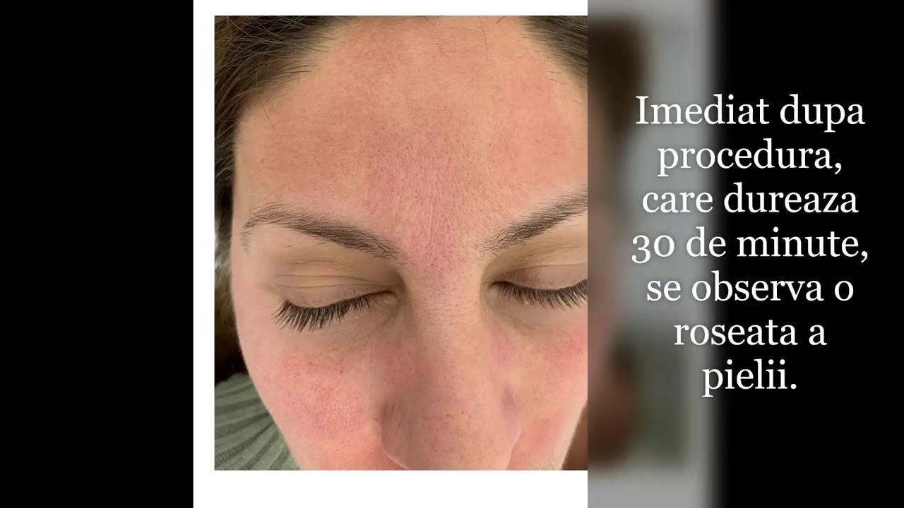 Radiofrecvență Trifracțională cu aparatul Maximus by Pollogen - YouTube