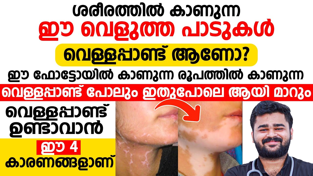 ശരീരത്തിൽ കാണുന്ന ഈ വെളുത്ത പാടുകൾ വെള്ളപ്പണ്ട് ആണോ | vella pandu ...