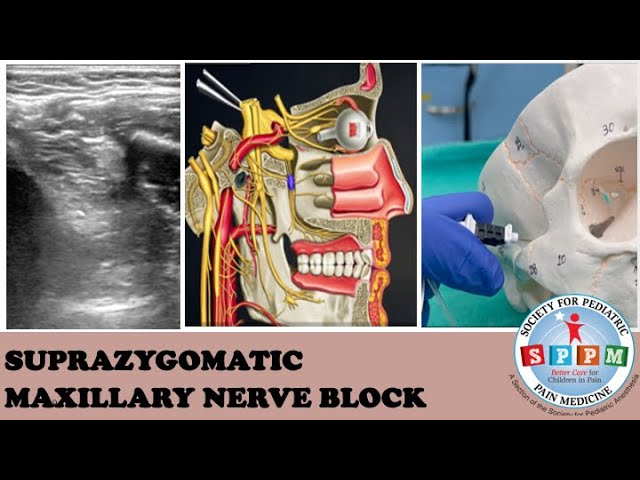 Maxillary Nerve Block Technique