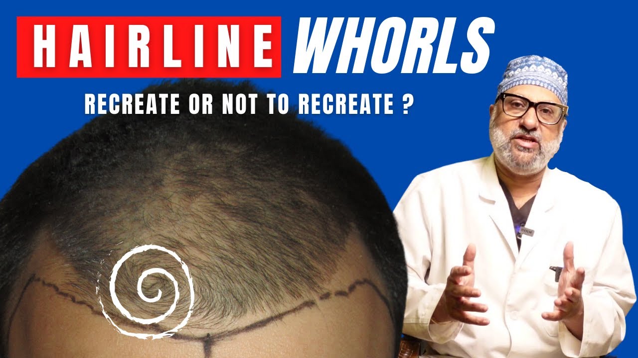 Hair transplant in India | Hairline Whorl patterns and Hair Transplant ...