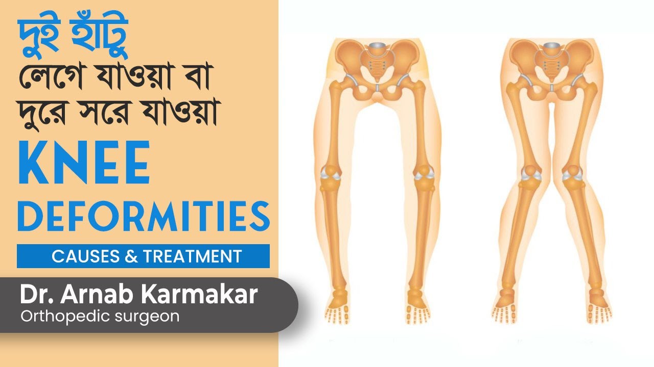 দুই হাঁটু লেগে যাওয়া সমস্যা দূর করার উপায় | Valgus & Varus knee ...