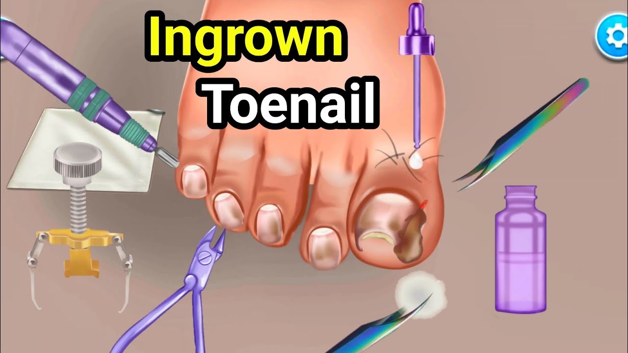 ASMR Ingrown Toenail removal treatment animation relax | Realistic ...