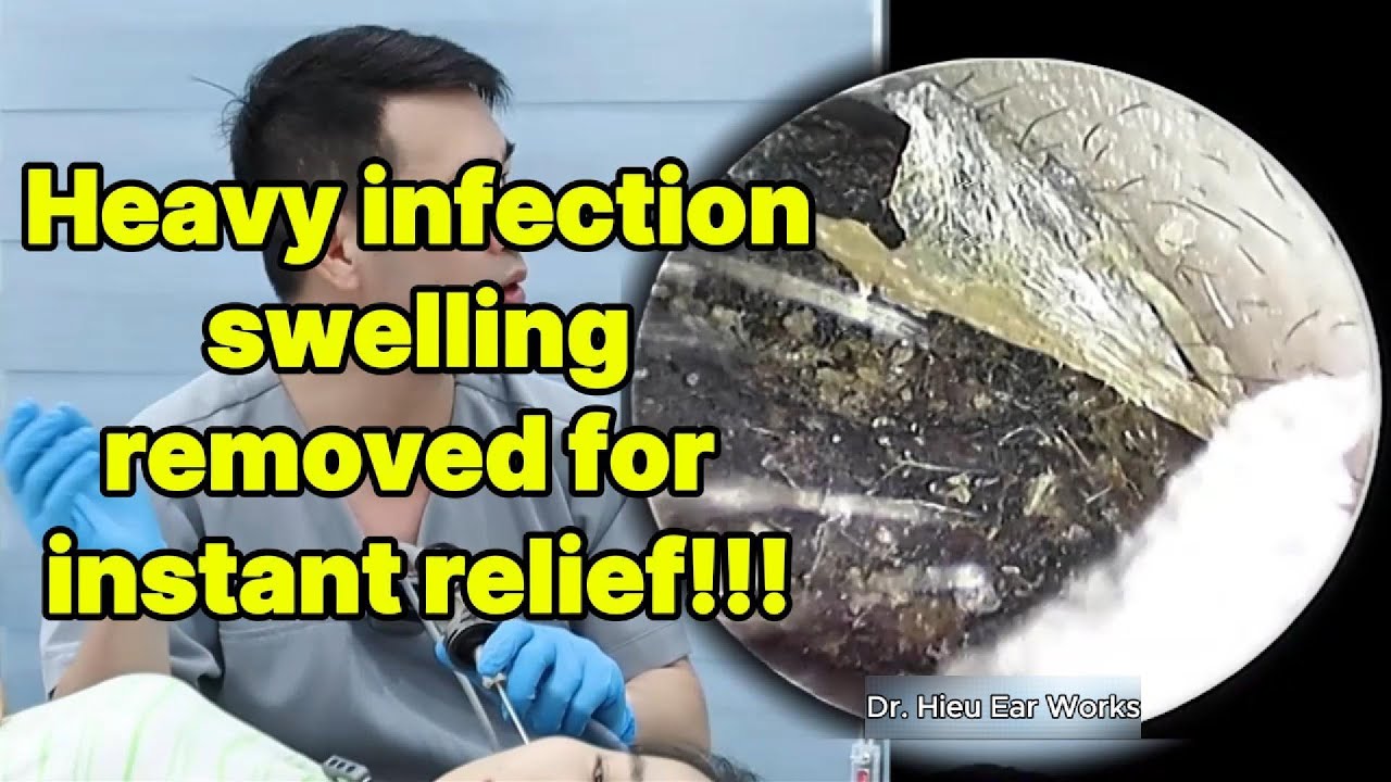 Heavy infection swelling removed for instant relie | ear cleaning ...