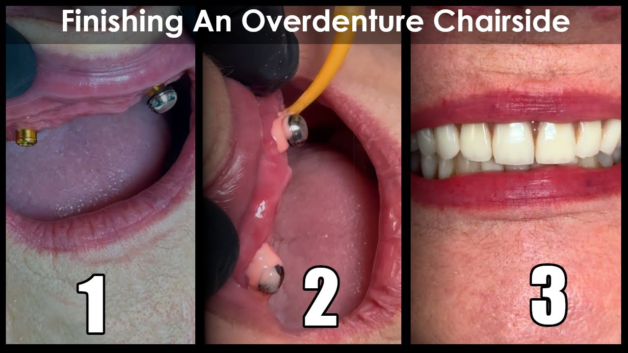 Watch An Overdenture Get Finished Chairside With the Patient - YouTube