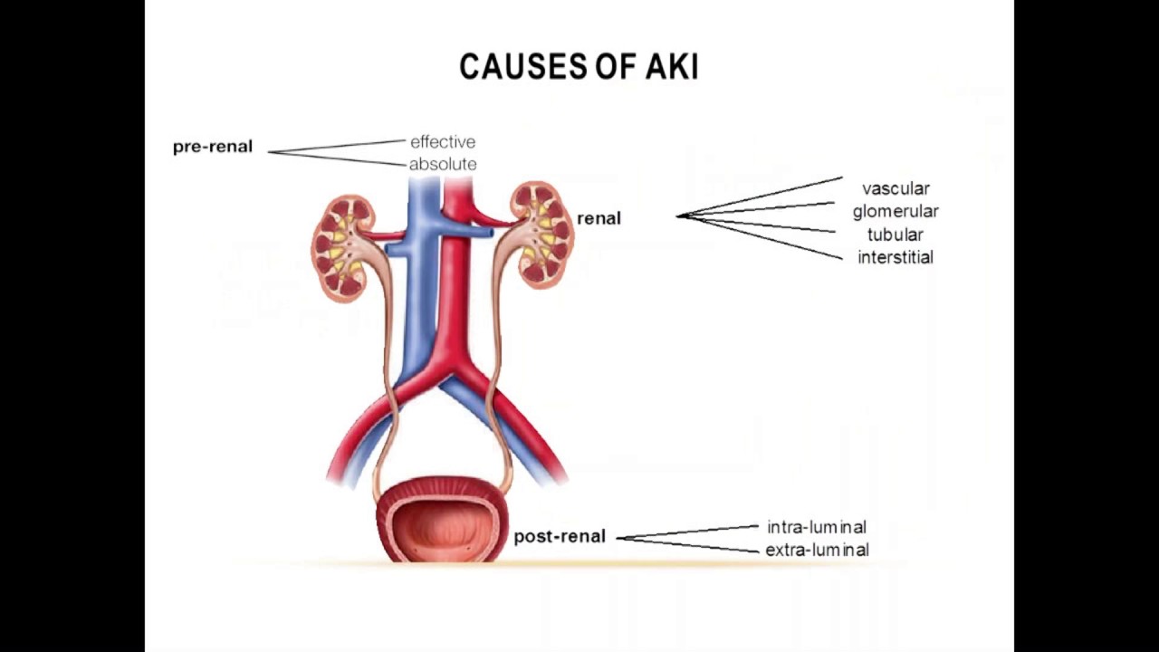 Acute Kidney Injury - A Primer for Primary Care Physicians (Nov 2016 ...