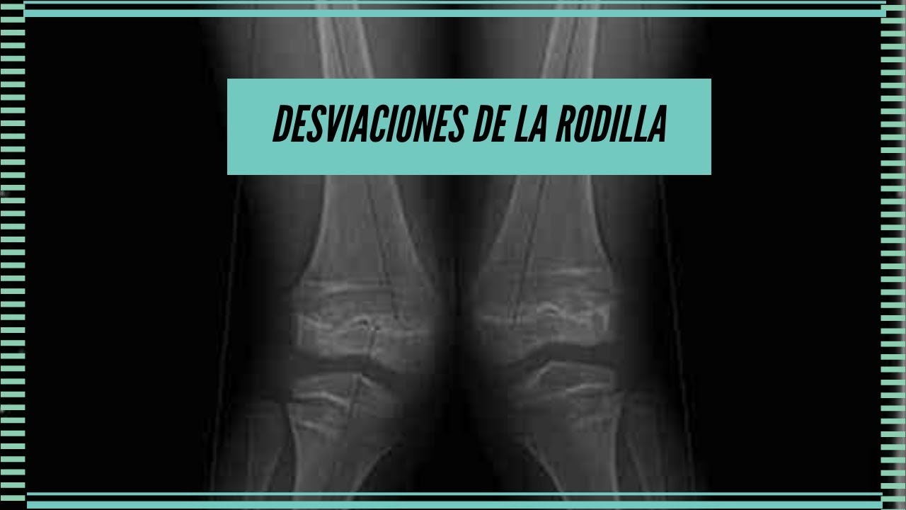 Desviaicones de la rodilla| Genu valgo y Genu varo - YouTube