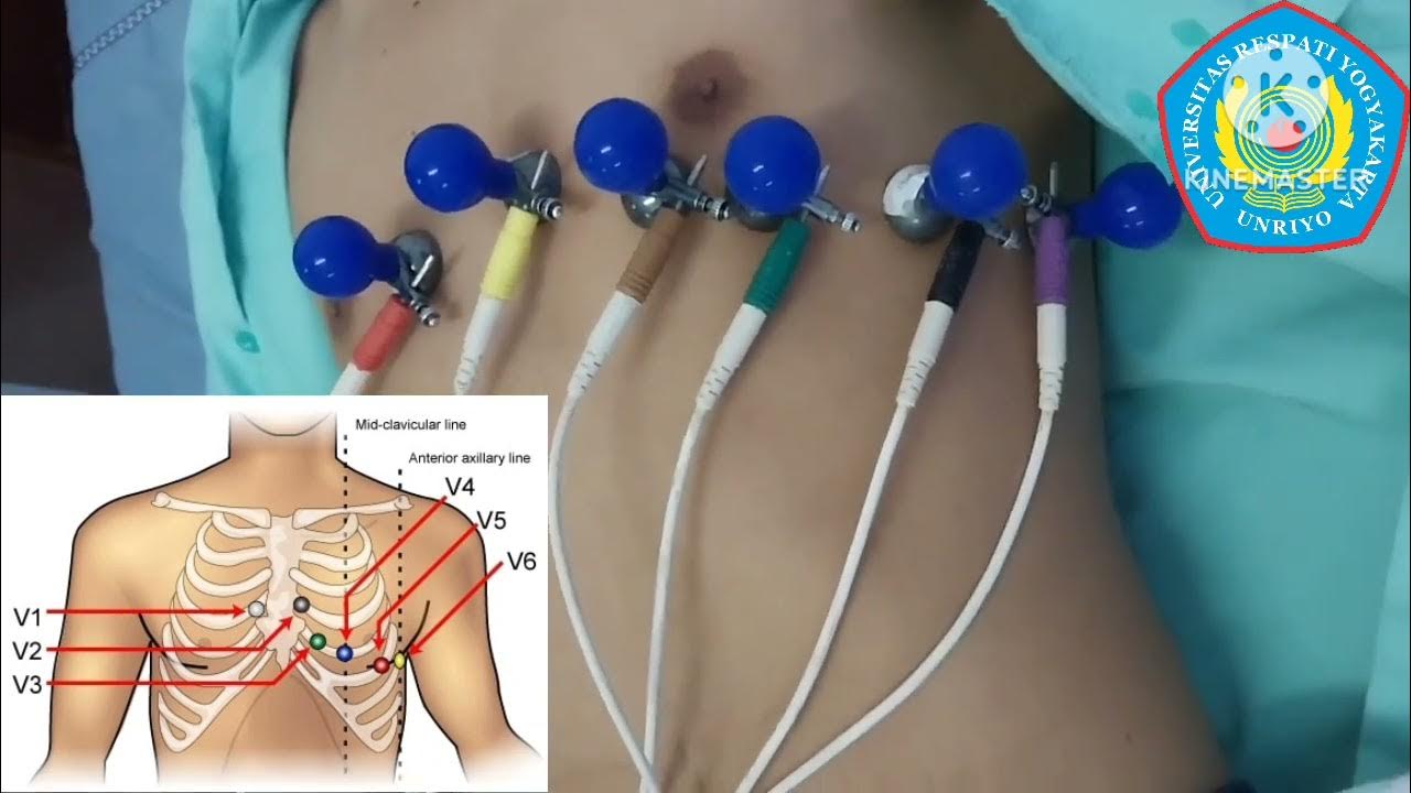 PEMASANGAN ECG - YouTube