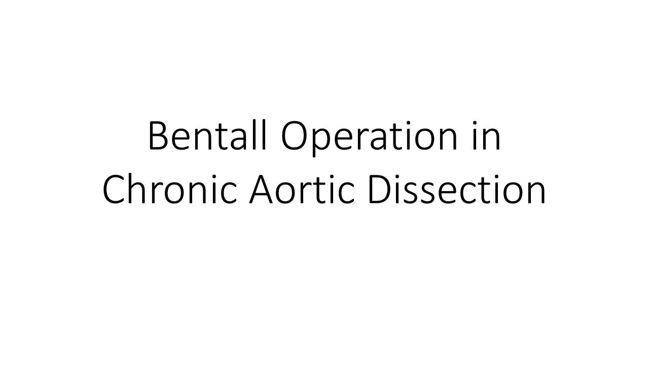 Bentall Operation in Chronic Aortic Dissection | Open Heart Surgery ...