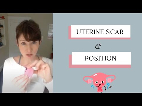 Uterine Scar Tissue - YouTube