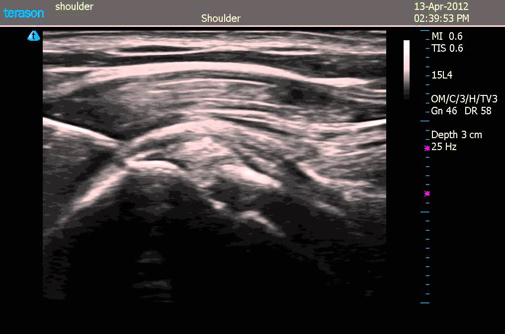 Terason t3200 MSK Ultrasound needle injection shoulder.avi - YouTube
