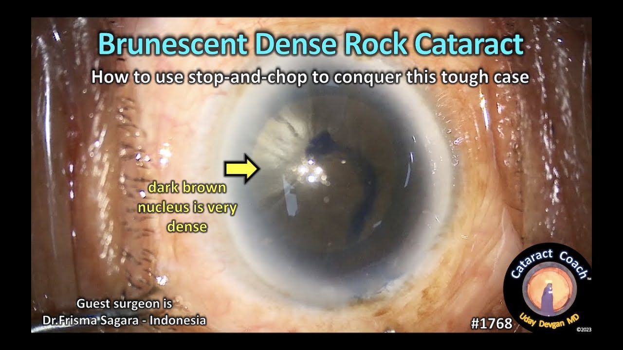 Cataractcoach™1768 Brunescent Dense Rock Cataract Youtube