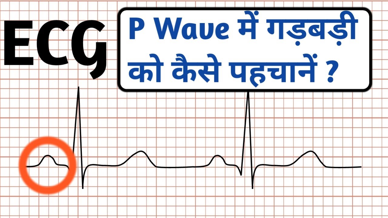 ECG में P Wave में abnormalities को कैसे जानें || p wave represents ...