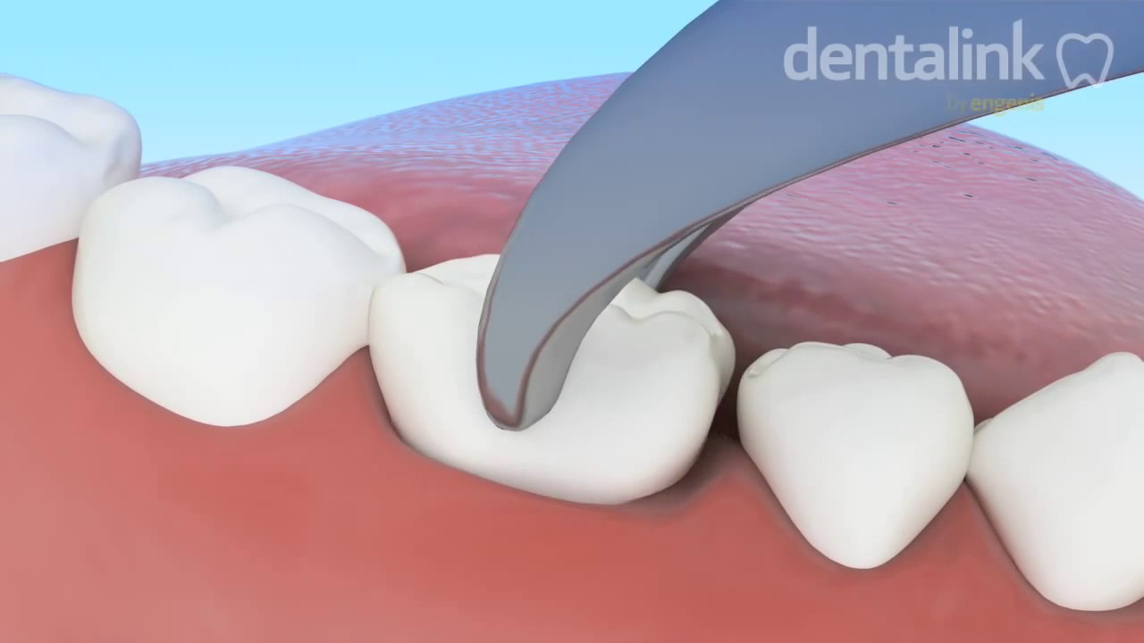 ¿Cómo es el procedimiento para las extracciones dentales? - Clínica ...